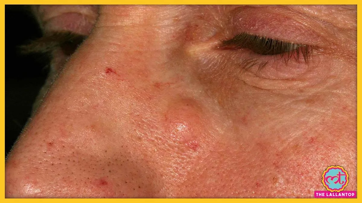 what is epidermoid cyst that causes internal bumps in skin