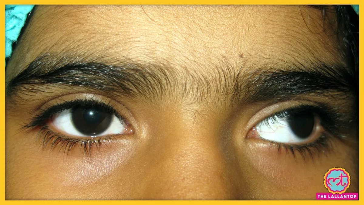 What causes squint eyes and how to treat it?