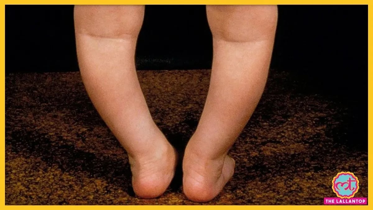 Find out what is rickets and how to treat it